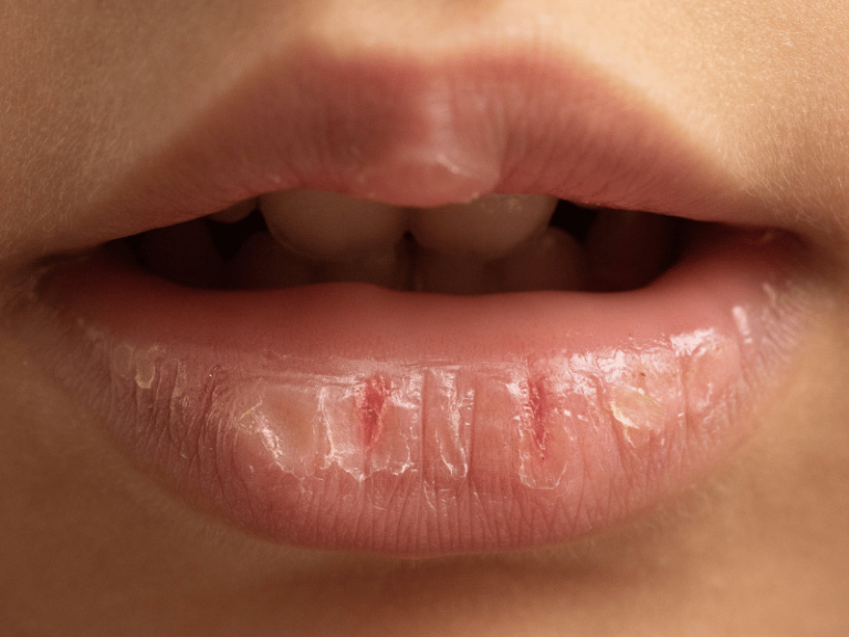 Why Do I Wake Up With Dry Mouth? 6 Causes and Solutions